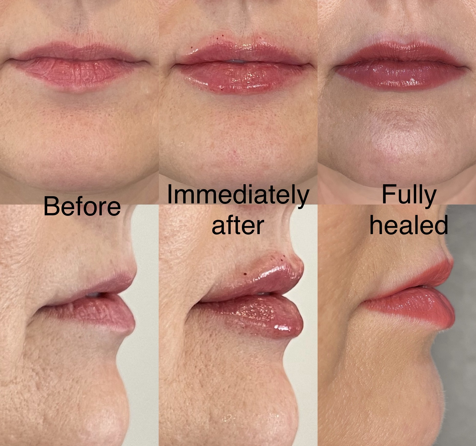 Filler Patient 3 - Florida Lakes Spa